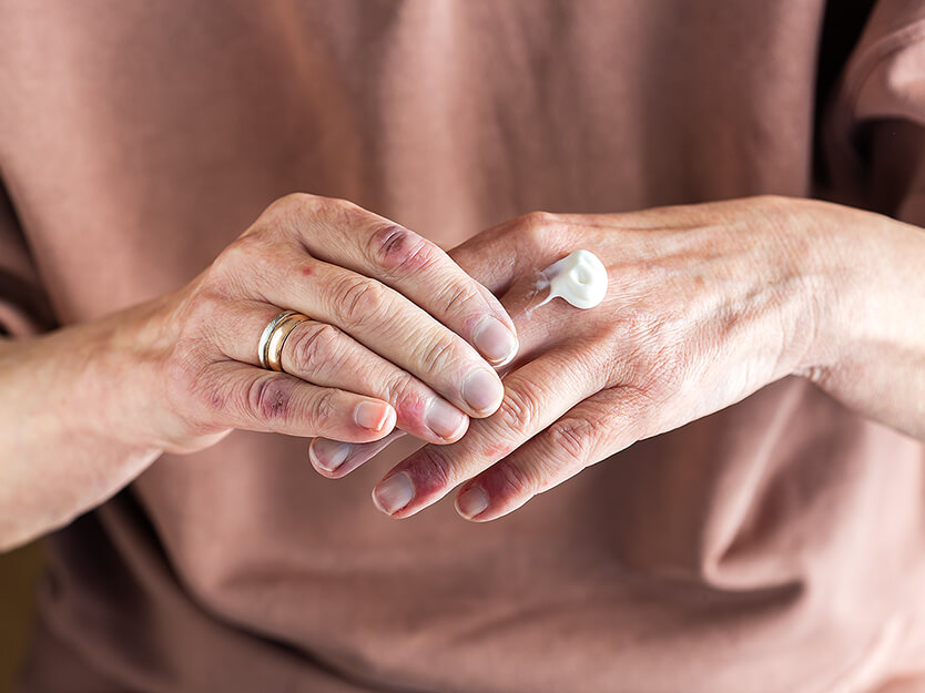 Dermatitis Del Anillo De Bodas Blanca Tratamiento Integral Para La